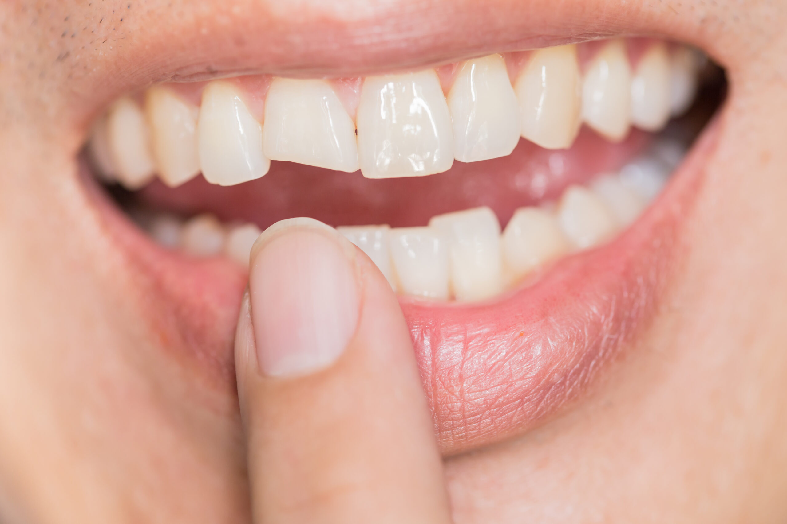 ¿Sabes qué hacer si tienes un diente roto o astillado? - Dentista Las ...